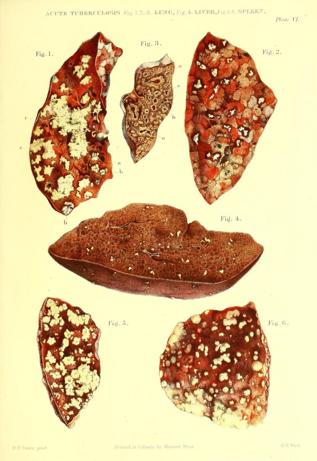Atlas patološke anatomije pluća, 1888. godina. - Fascija.com